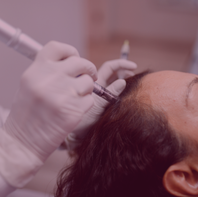 Microagulhamento Capilar - Cepelle Dermatologia | Curitiba